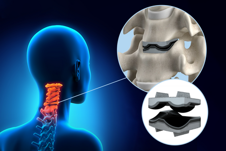 Invest In Dymicron: Delivering Stronger And Long-Lasting Cervical Disc ...